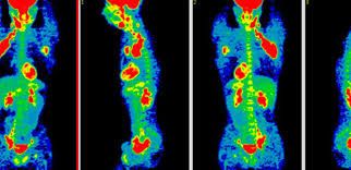 medicina-nuclear-pet-scan - Vita Imagem